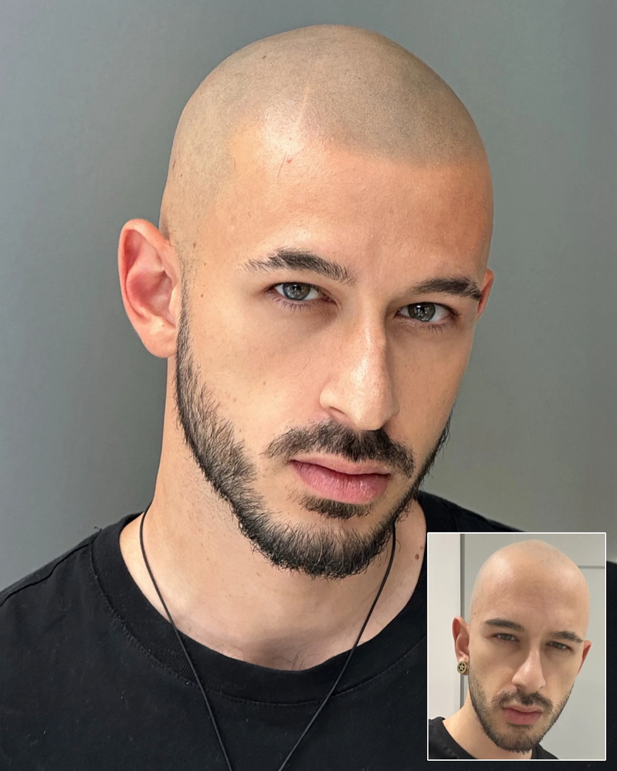 Hairline Pigmentation Manchester: Achieve a Flawless Look with Micro ...