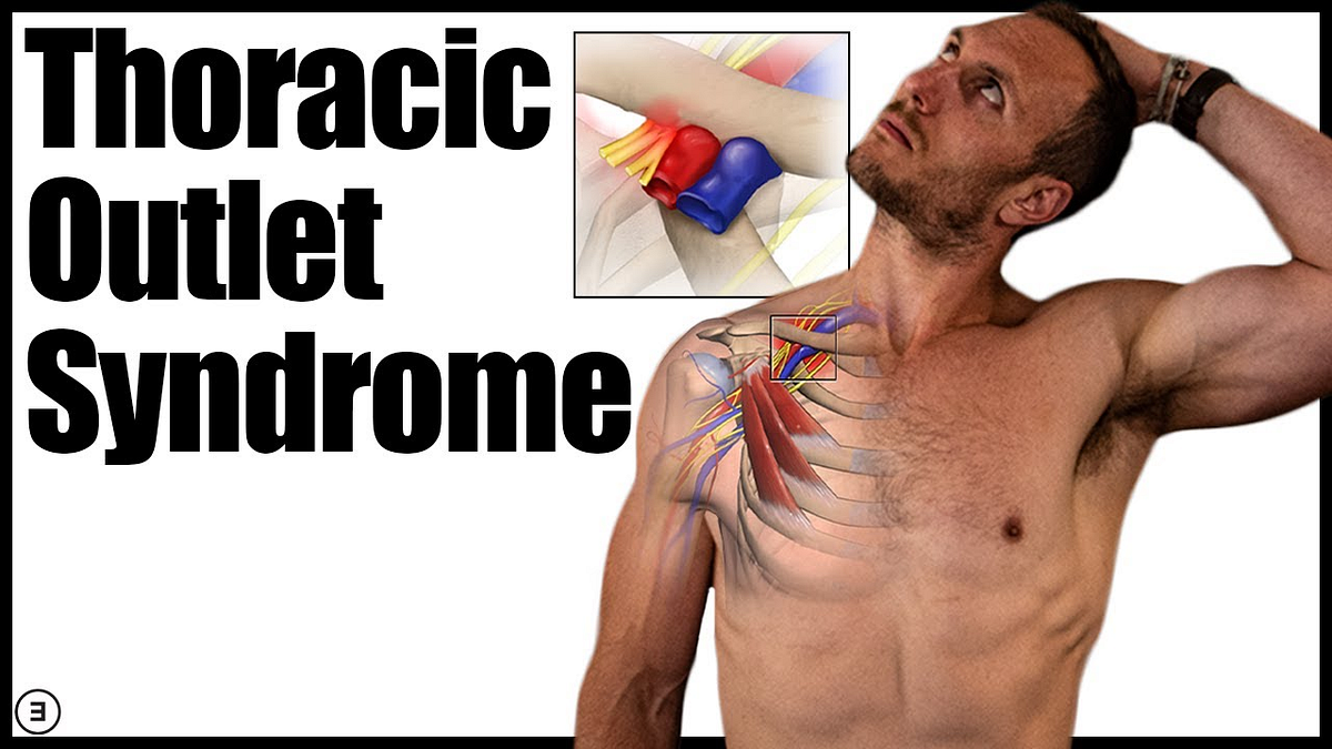Everything About Thoracic Outlet Syndrome: Treatment | by Dr. Ahsan Ali ...