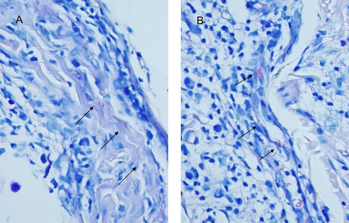 Lepra Bonita (Pretty Leprosy). If you’re looking for a way to get… | by ...