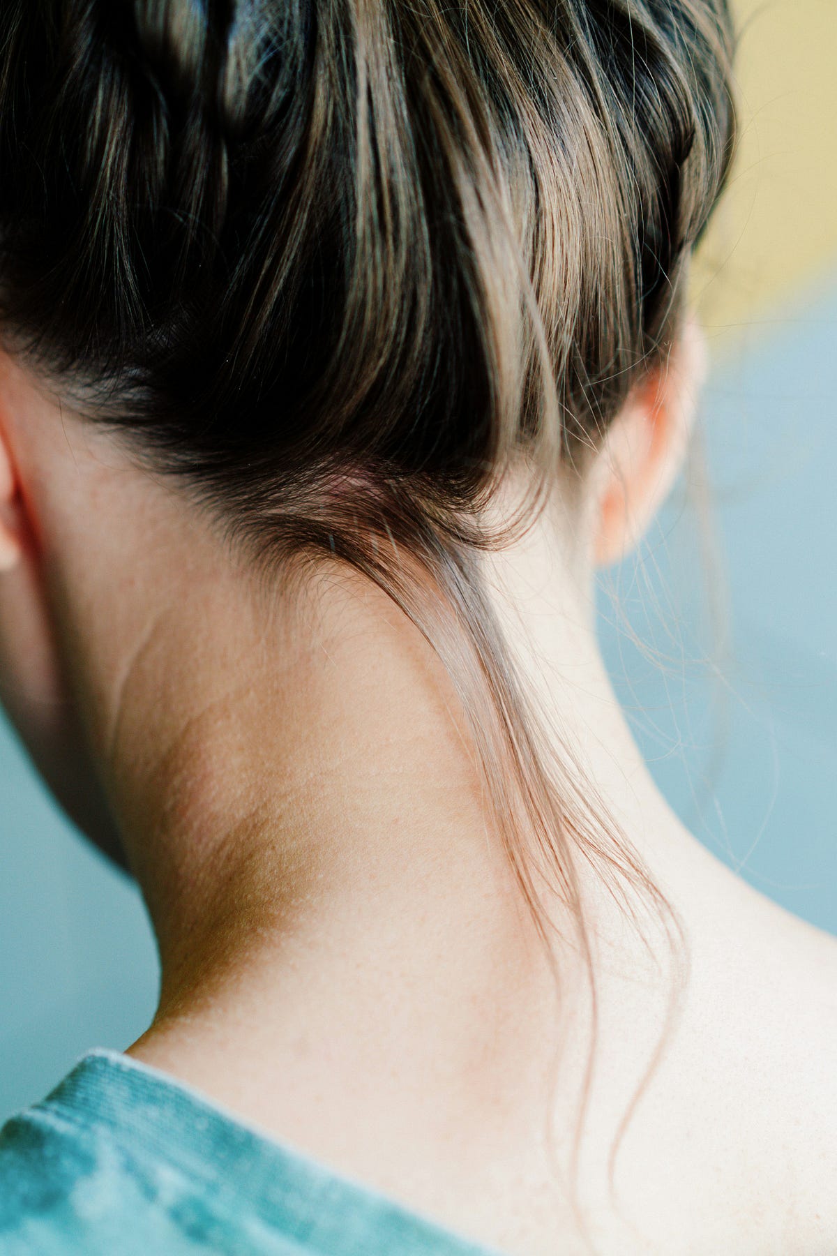 What is a Buffalo Hump?. Fat deposition in the back of the neck… | by ...