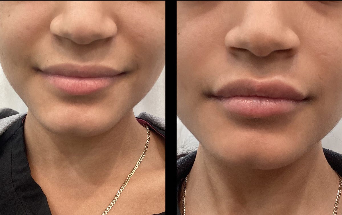 Injectable Fillers in Weston, FL: Enhance Your Natural Beauty at Singh ...