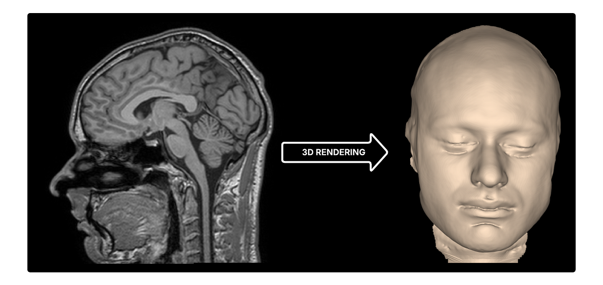 Head MRI Anonymization: GenAI to Lower Re-ID Risk | Medium