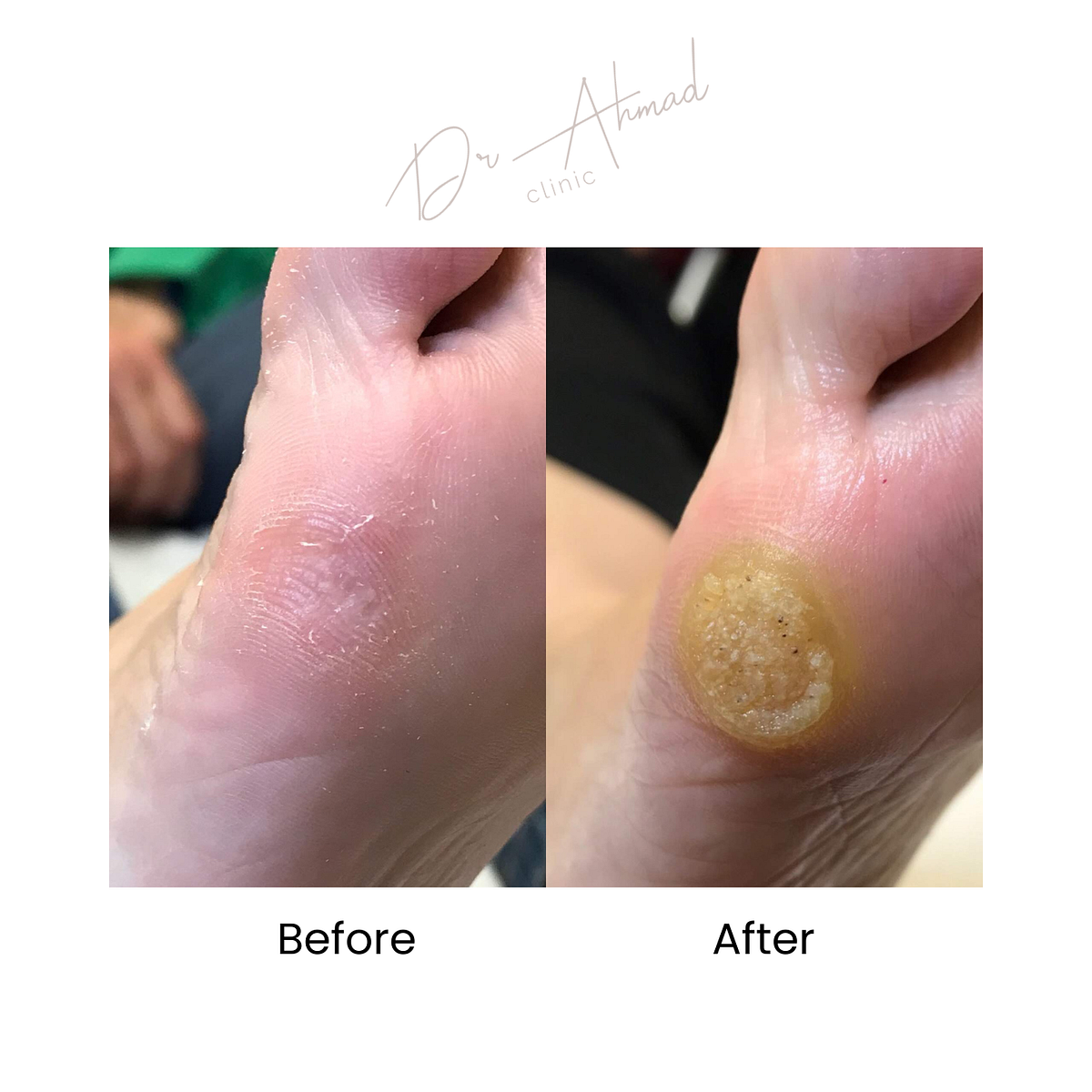 scarsSole Searching: Your Comprehensive Guide to Verruca Removal | by ...