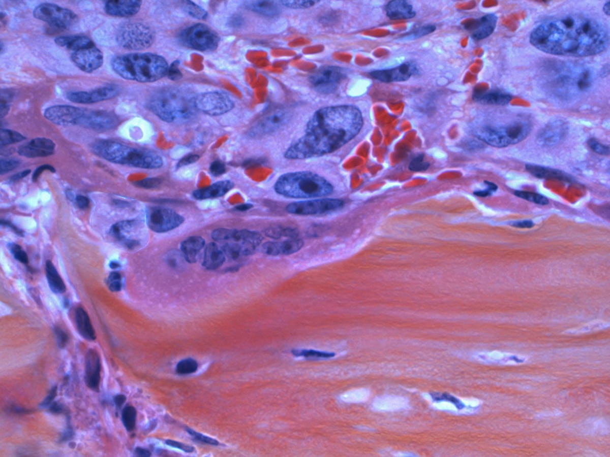 Skin Cancer Detection Algorithm. A Kaggle Competition Hosted by ISIC ...
