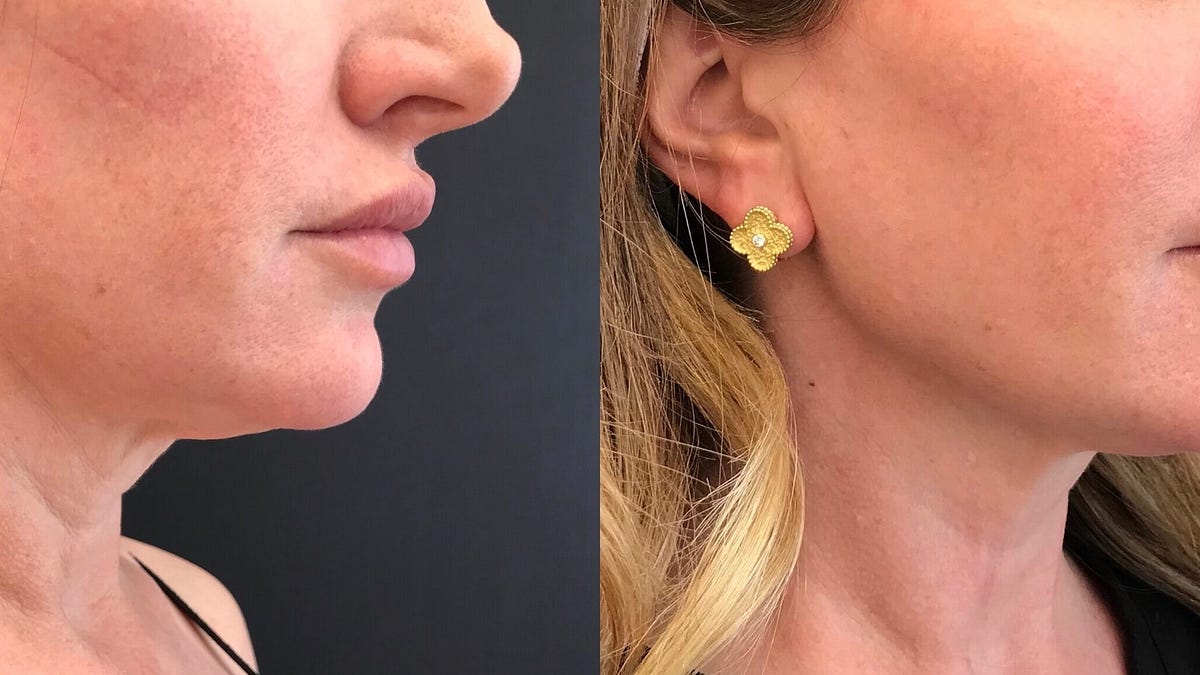 Top 5 Benefits of PDO Thread Lifts for Facial Rejuvenation | by Muhammad Azfar | Jul, 2024 | Medium