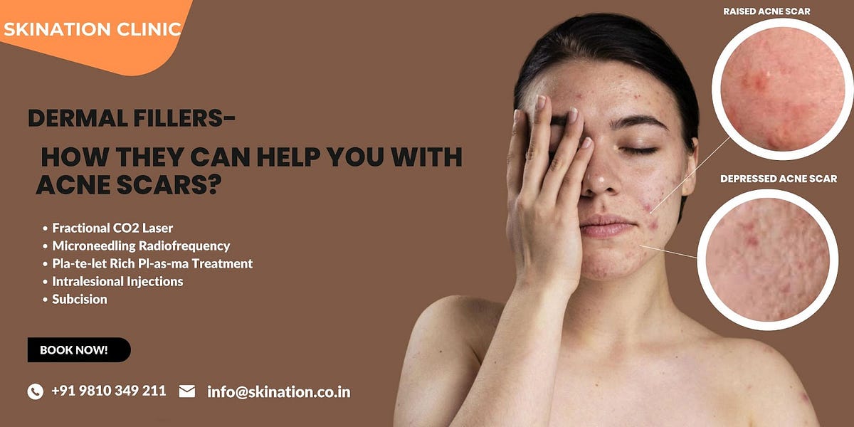 Dermal Fillers- How They Can Help You With Acne Scars? | by ...