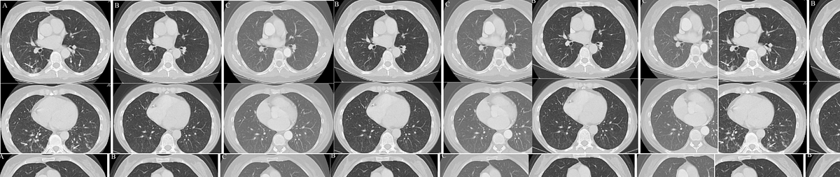 “MLOps for Chest CT Scan Image Classification: A Step-by-Step Guide” | by Mashudu Mudau | Medium