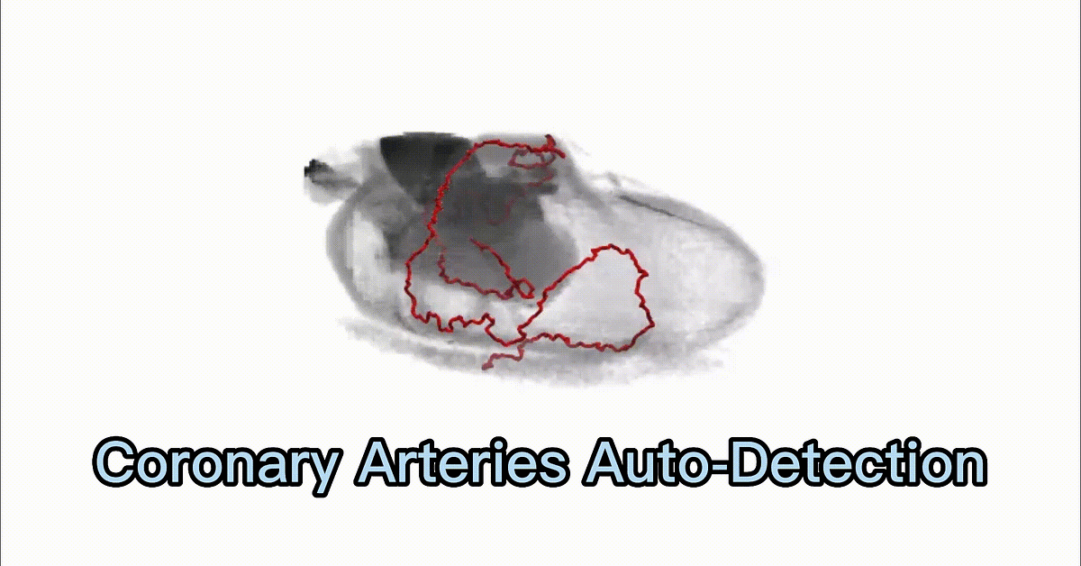 Detect Coronary Arteries from CCTA | by Yijin Mao | Nov, 2024 | Medium