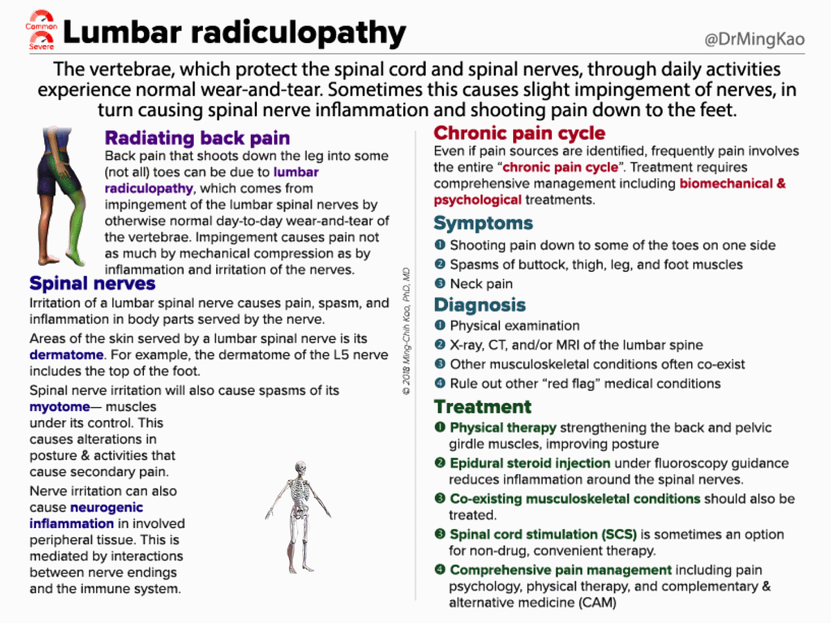 Lumbar radiculopathy. The vertebrae, which protect the spinal… | by Dr ...