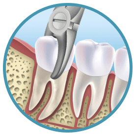 Complete Painless Extractions by Hungary Dental Implant | by Victor ...