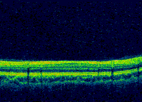 Machine Learning and OCT Images — the Future of Ophthalmology | by ...