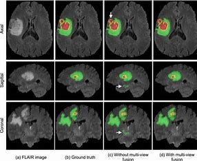 Image Segmentation Project for Brain Tumor Prognosis | by Kinshuk ...