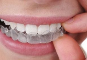 Pathak Dental Clinic: Invisalign Treatment in Akurdi | by Pathak Dental Clinic | Jun, 2024 | Medium