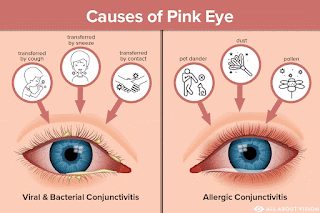 Understanding Pink Eye (Conjunctivitis): Causes, Symptoms, and ...