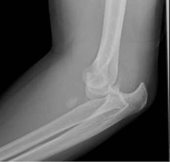 Quebraduras de codo. La articulación del codo está formada… | by Obras ...