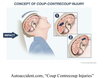 CTE: Effects on Athletes. CTE: Effects on Athletes | by Ashwin | Medium