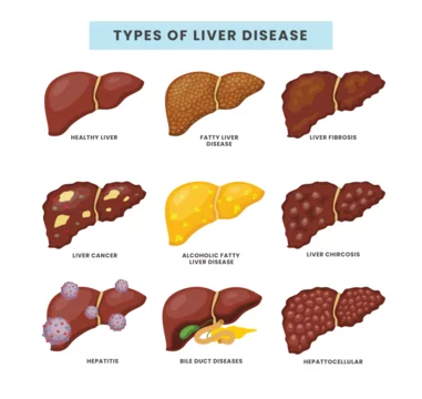 What are the signs of fatty liver, and what can I do to reverse it ...