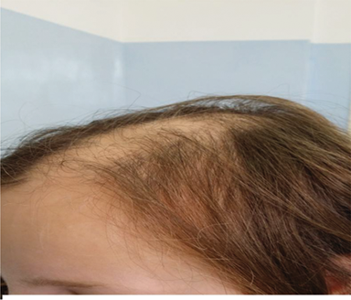 Hair Loss in Children: Causes and Treatment | by The Glo Medispa | Dec ...