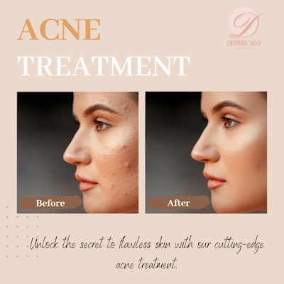 Derma 360’s Tailored Approach to Acne Treatment in KPHB | by ...