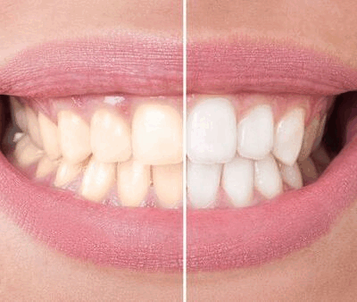 Teeth Whitening in Hicksville, Flushing & Floral Park. - Prestige ...