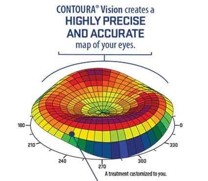 Contoura: A Revolutionary Step in Vision Correction | by Hales smith ...