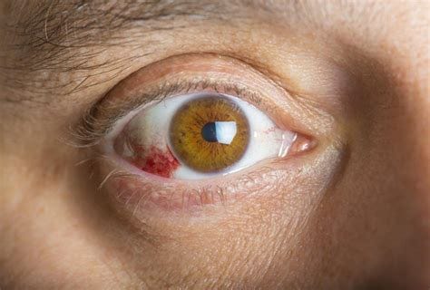 Eye Hemorrhage Behind Eye: Causes & Info | by Zacharypollard | Jun ...