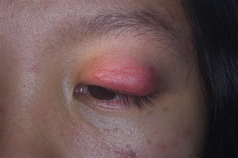 Cellulitis of the Eye: Uncovering the Causes and Risks | by Quintonkaur ...