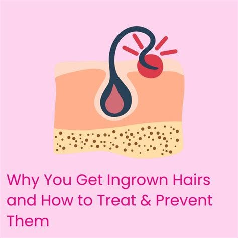 Review (2025) Banish Ingrown Hairs: Serums and Expert Tips - Is Valotin ...