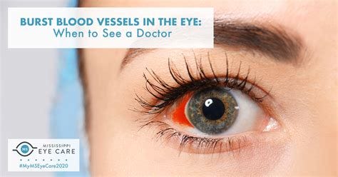 Eye Blood Vessel Pop: Causes & What It Means | by Jennifermccullough ...