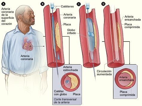 Angioplasty: Understanding the Procedure, Benefits, and Recovery | by ...