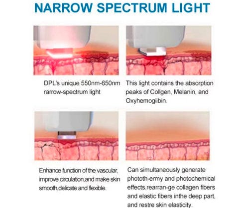 Unraveling the Science Behind DPL Laser: How Does It Work? | by ...