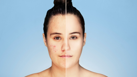 How to Treat Acne Naturally?. Acne is a common skin condition that ...