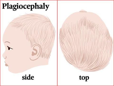 Treatment of Flat Head Syndrome in Babies (Plagiocephaly Positional ...