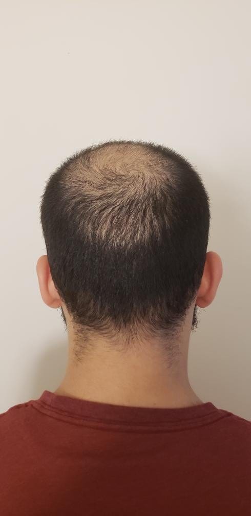 FUSS Hair Transplant vs. Other Methods: What Sets It Apart? | by ...