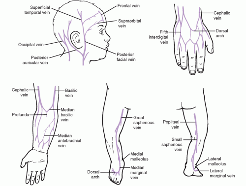 Main Types of IV Line Cannula. When administering medication, taking ...