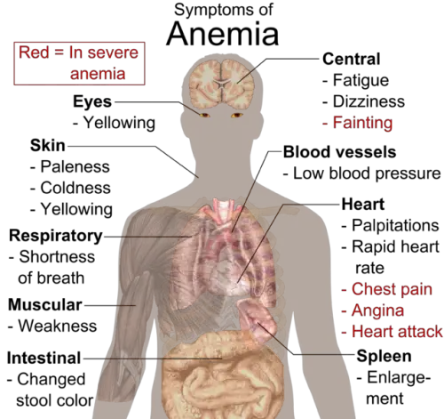 Interesting Anemia Facts.Iron Deficiency | by Jugenaz | Medium
