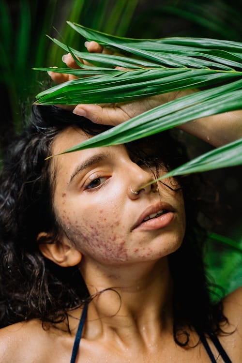 The Pimple Posse: Foods That Are Breaking You Out (and How to Kick Them ...