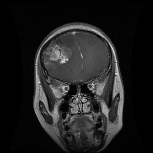 Comparing CNN and Prototypical Networks for Brain Tumor MRI ...