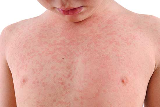 Hives (Urticaria) in adults: Condition, causes and treatments | Zyla ...