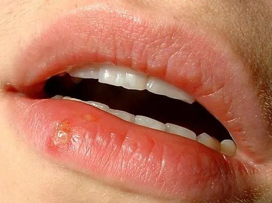 There is no such thing as lip pimples | by Openedpandorabox | Medium