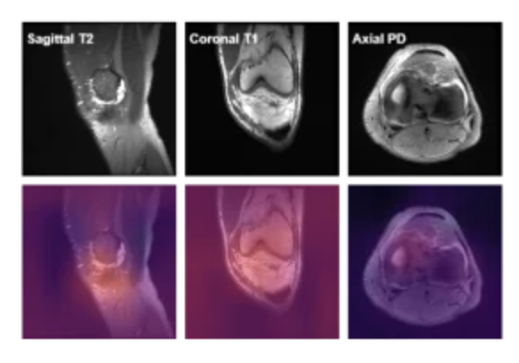 Classifying Knee MRI Scan with CNN | by Chhun Hong | Medium