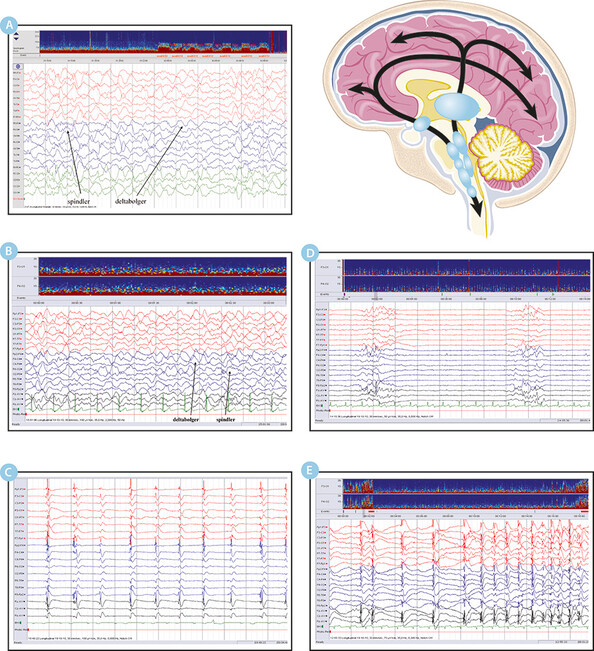 Brain Activity During Coma: The Process of Brain Wave Change and ...