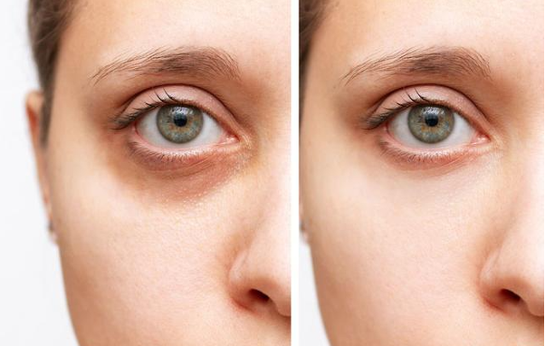 There are 4 types of dark circles, let me teach you how to distinguish ...