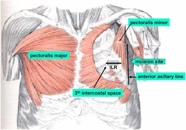 Implantable Loop Recorder. The implantable loop recorder (ILR) is… | by ...