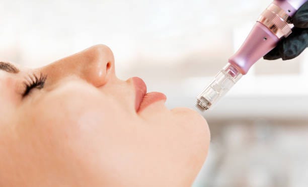 Why Dermapen Facials Are the Secret to Flawless Skin | by Nora's Beauty ...