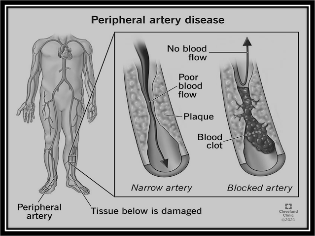 Peripheral arterial:. Definition: | by Medical nutritional therapy ...