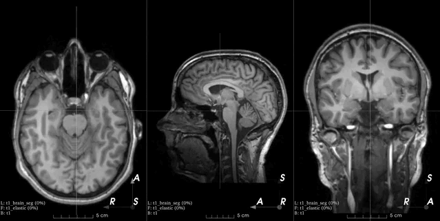 Introduction to TorchIO for 3D MRI Processing: Augmentation Transforms ...