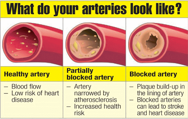 8 Foods That Could Help Unclog Your Arteries | by Health Tips | Medium