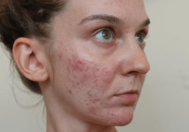 How to explain Radio Frequency Treatment for Acne Scars? | by ...