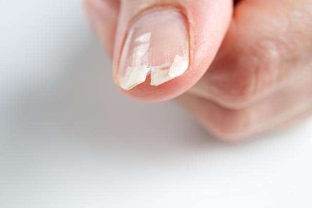 Why Your Nails Are Losing Their Strength : Cracked, Brittle, and Weak ...